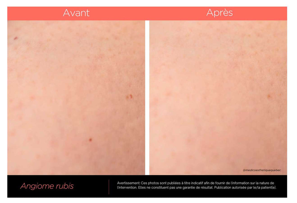 Angiome rubis au laser : Avant / Après – Clinique médico-esthétique de ...