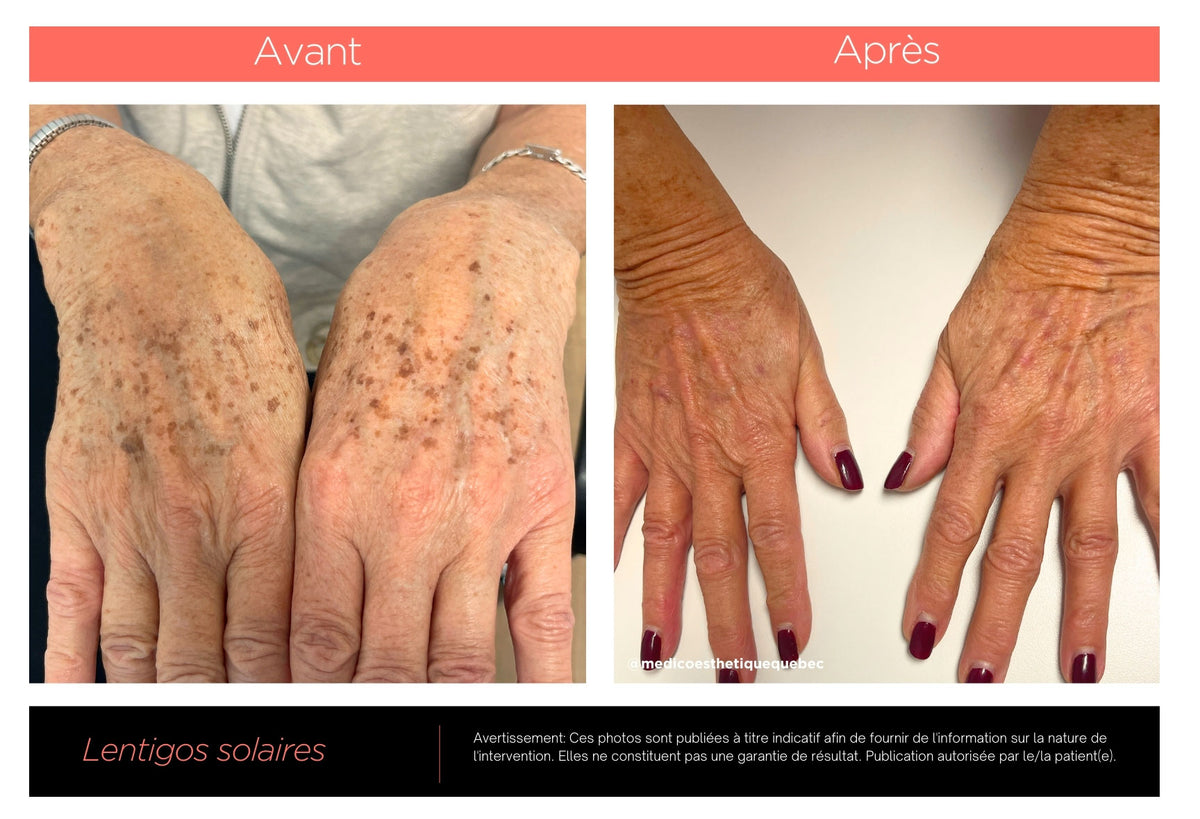 Comment enlever les taches brunes sur les mains? – Clinique médico ...