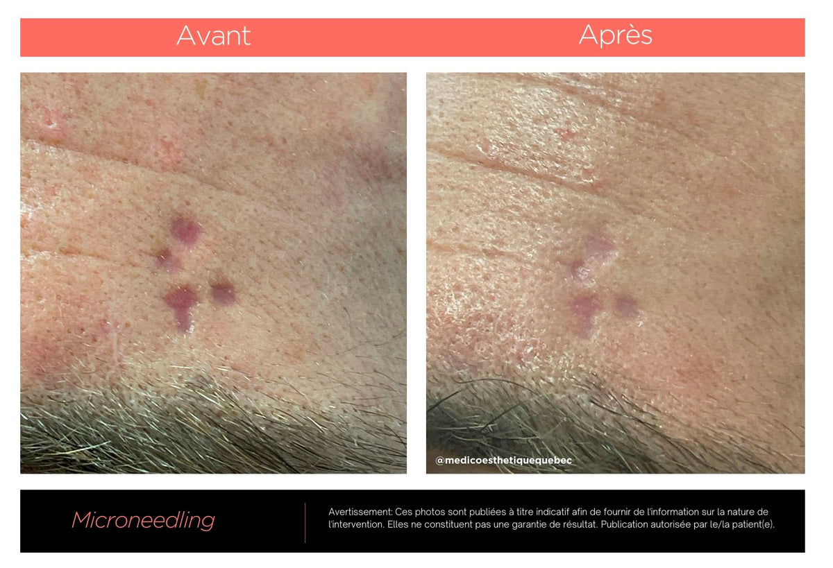 Dp4 Microneedling: Avant/Après cicatrice – Clinique médico-esthétique ...