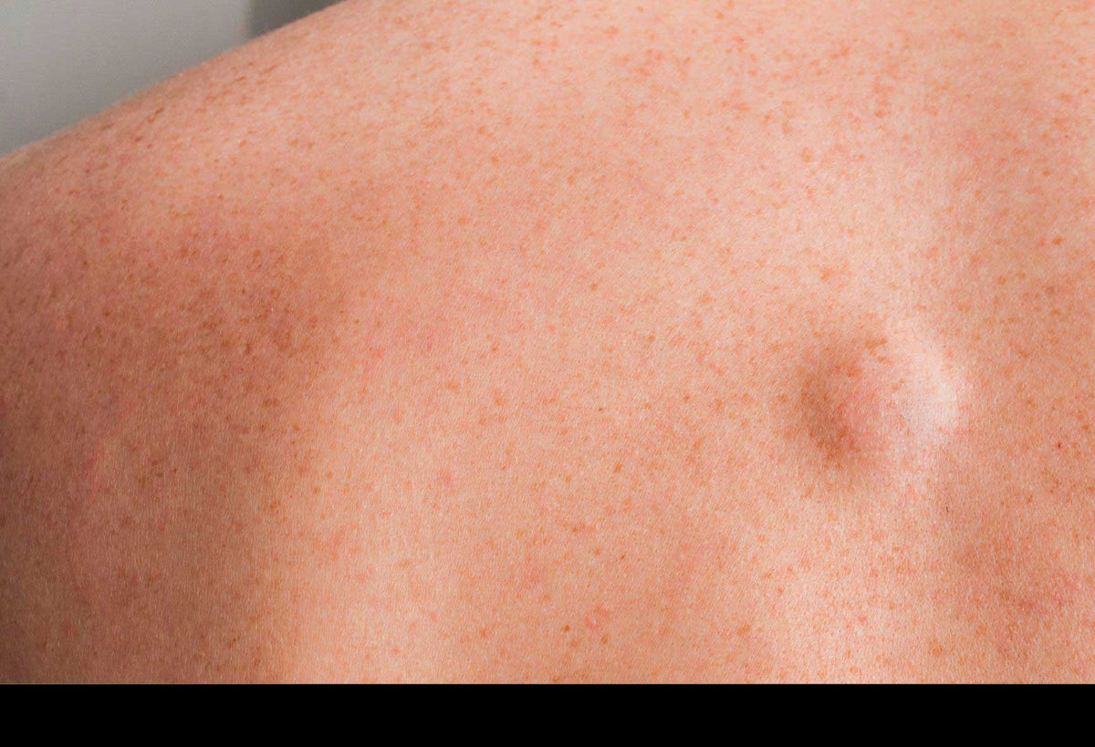 Lipome dans le dos: traitement & ablation – Clinique médico-esthétique ...