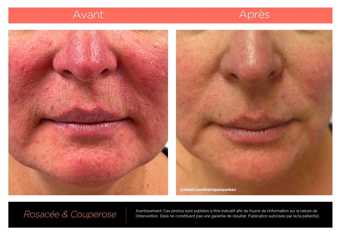Couperose et rosacée: Traitement IPL – Clinique médico-esthétique de Québec